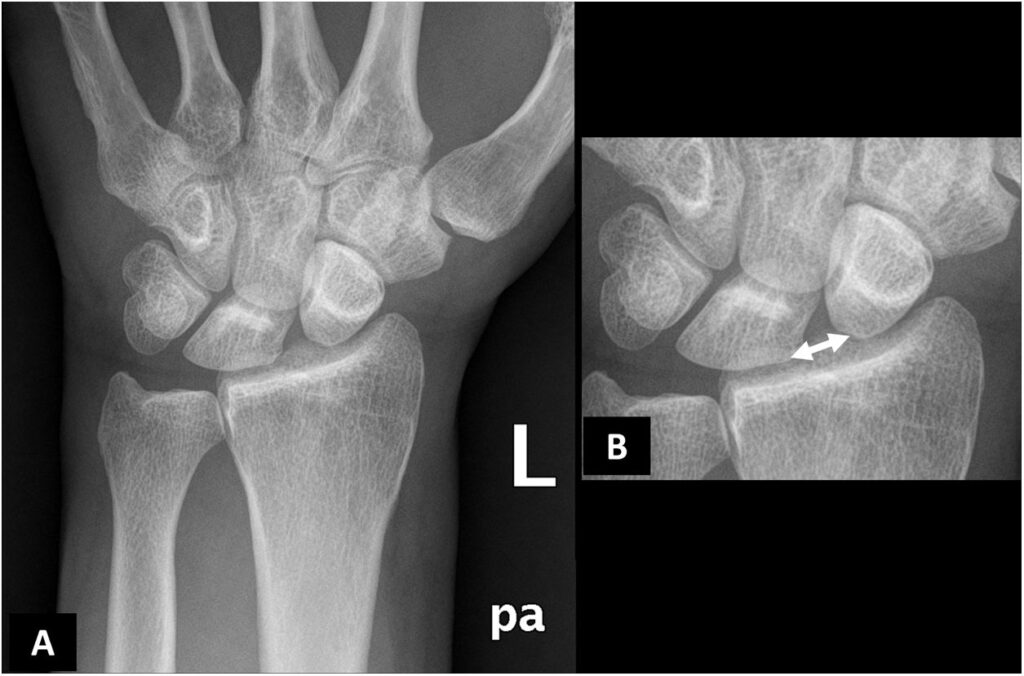 Lesioni della del complesso fibrocartilagineo triangolare (TFCC) del ...